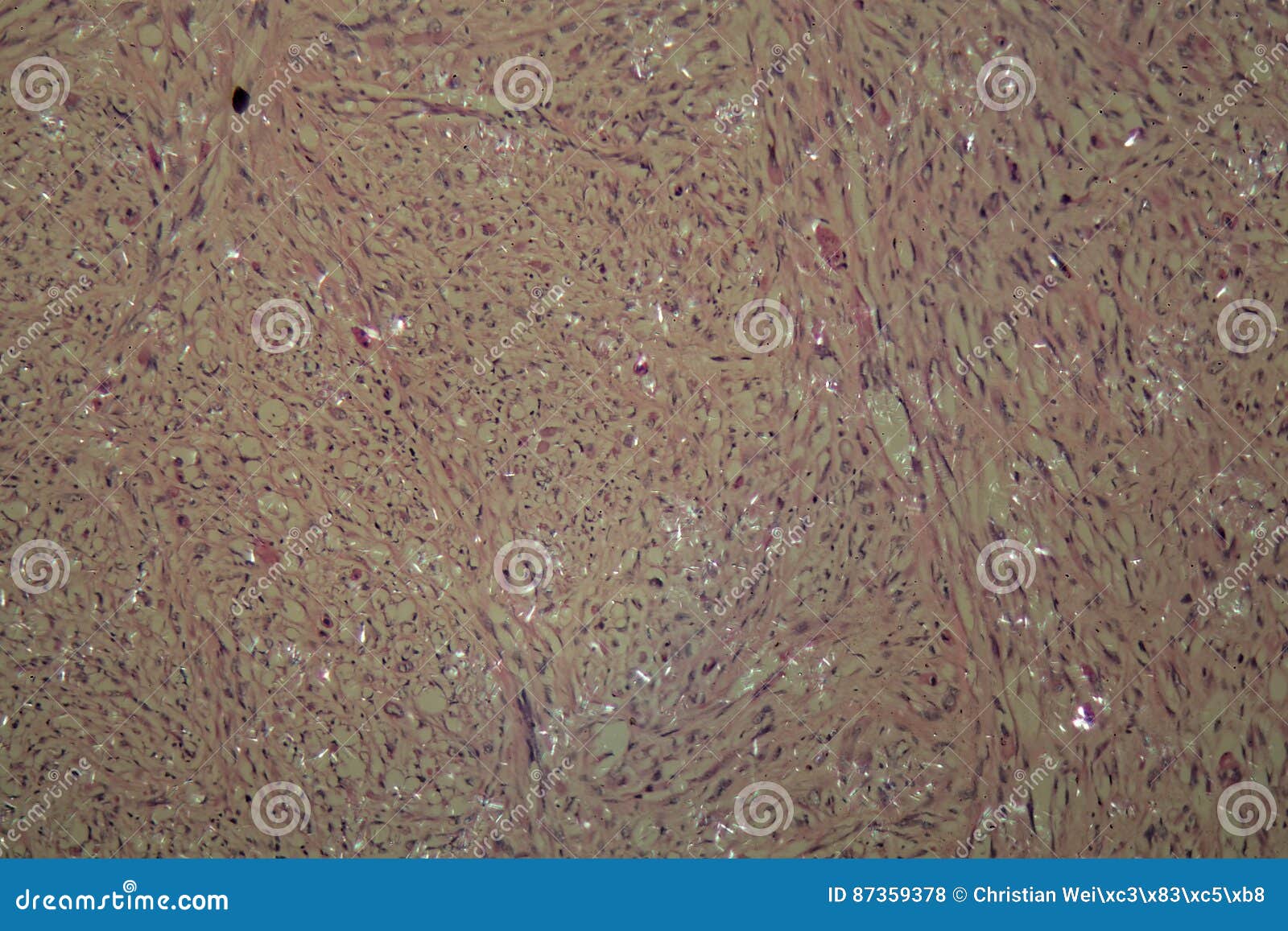 Cells of testicular cancer stock photo. Image of mammalian - 87359378