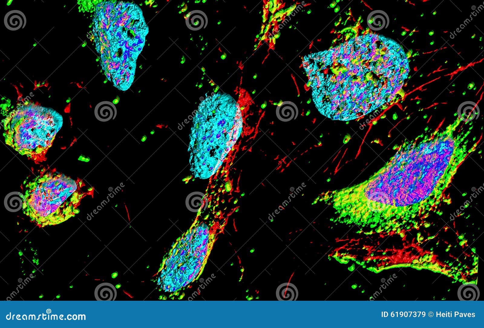 Cellules Cancéreuses Cervicales Hela Image stock - Image of tumeur ...