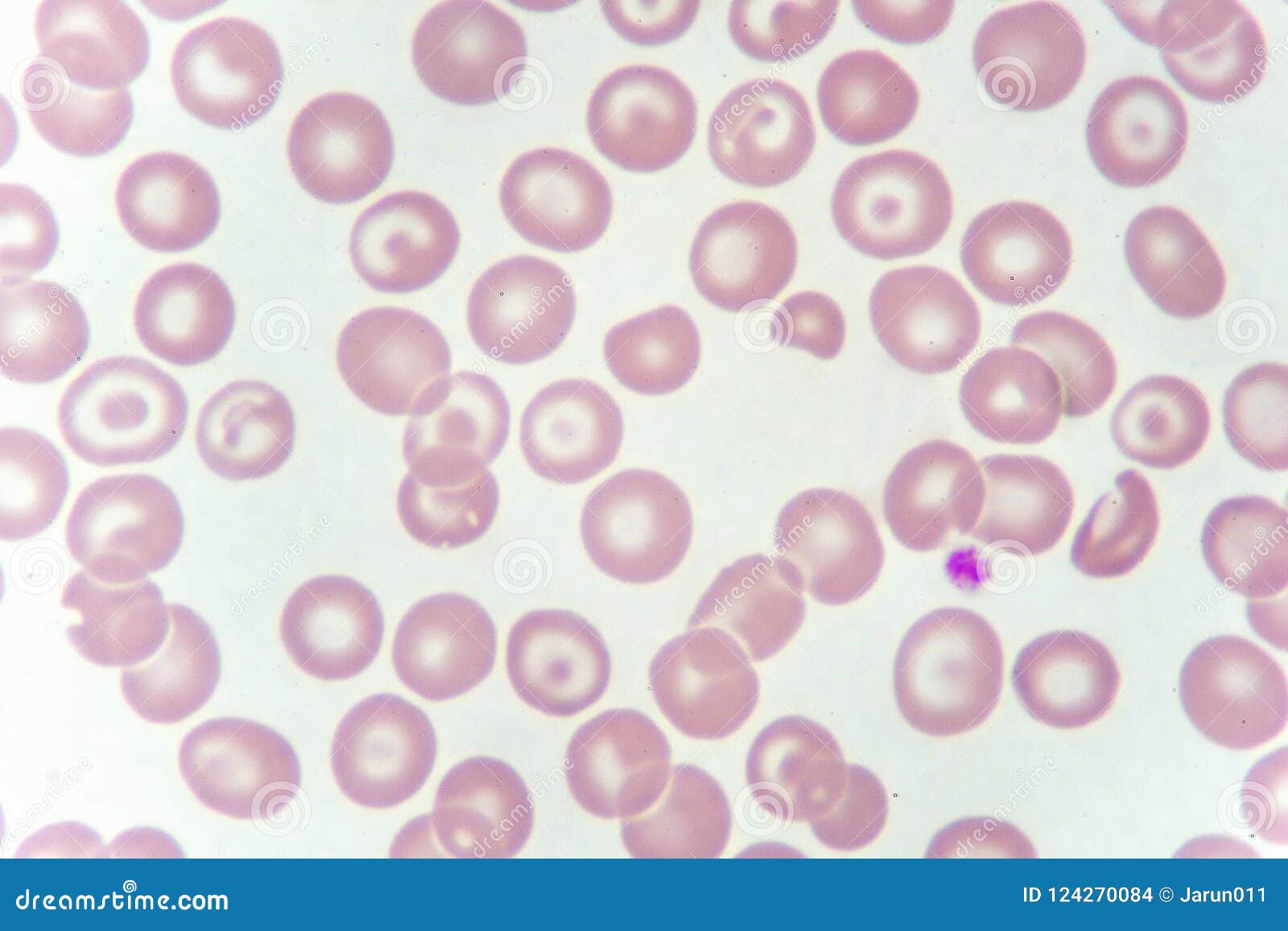 Cellules Cibles Avec Les Globules Rouges Anormales Photo stock - Image ...