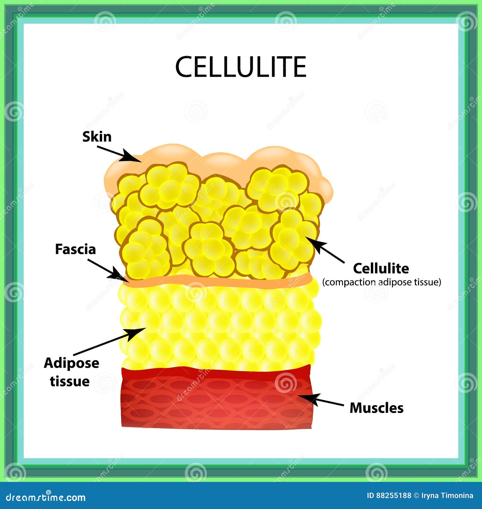 Cellulitis Cartoons, Illustrations & Vector Stock Images - 59 Pictures ...