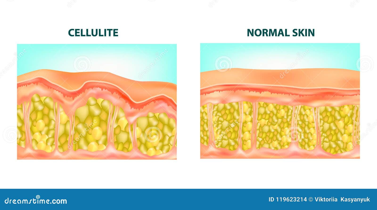 Cellulite formation. stock vector. Illustration of healthy - 119623214