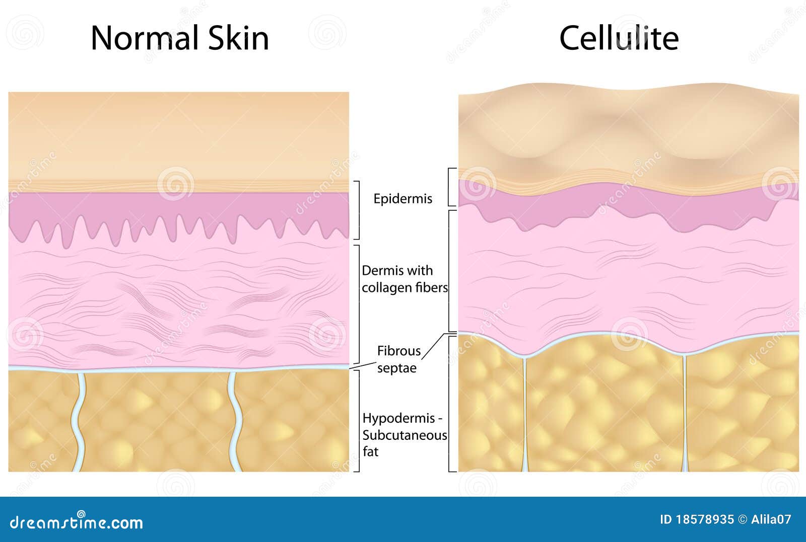 Cellulites Contre La Peau Lisse Illustration de Vecteur - Illustration ...