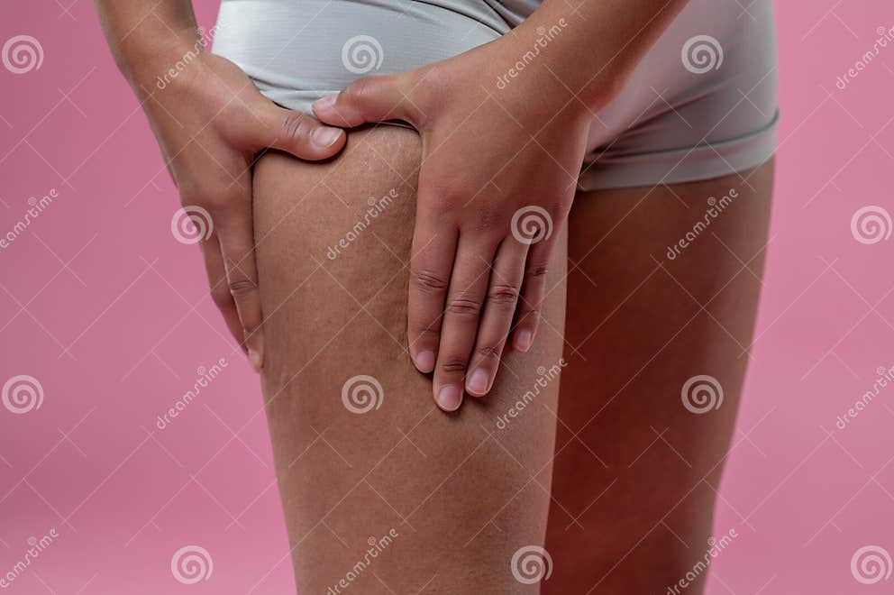 Close Up Of Woman Checking Her Legs On Cellulitis Stock Image Image Of Adult Skin 285794027
