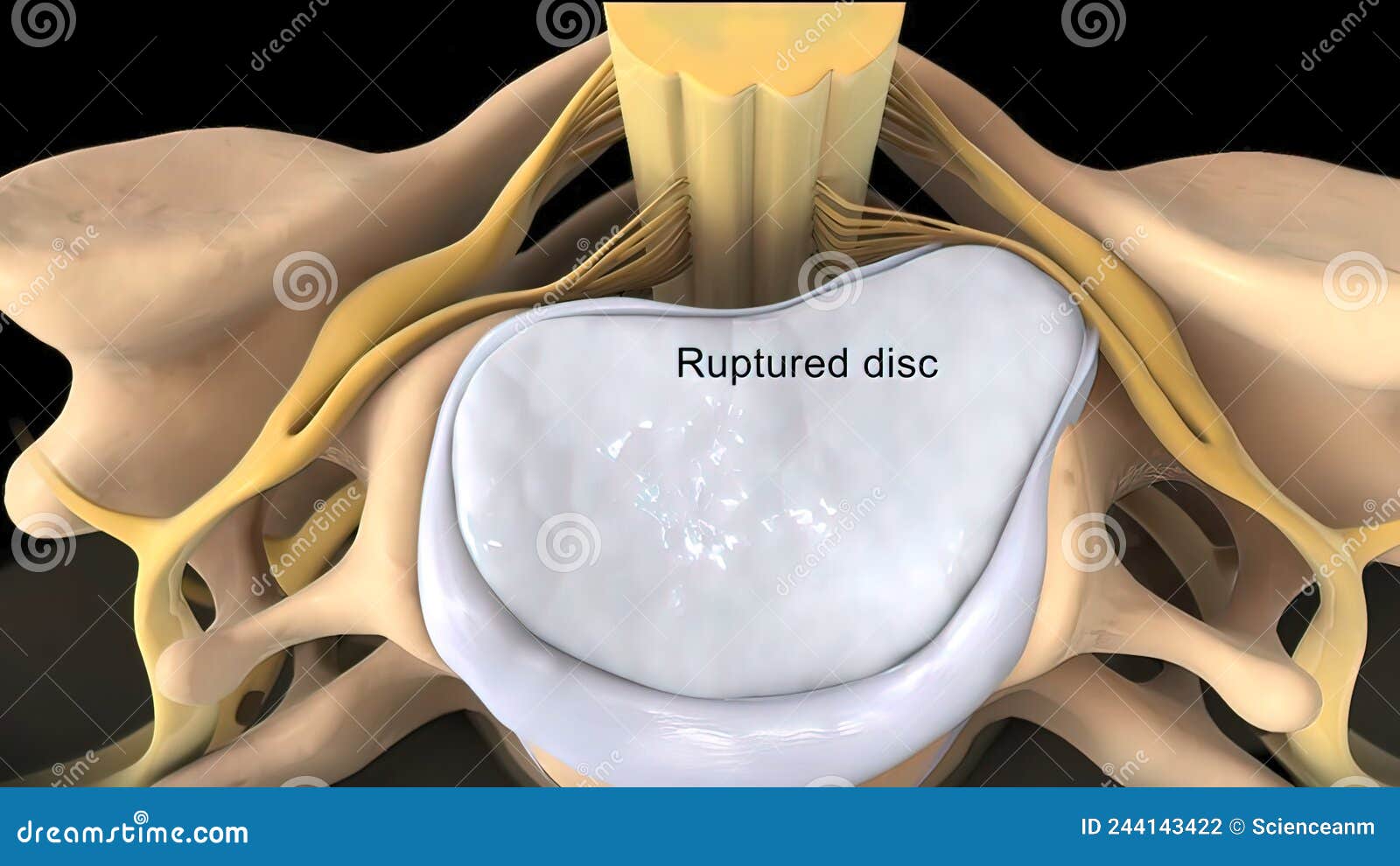 Disc Protrusion. Top View. Spine. Infographics. Vector Illustration On ...