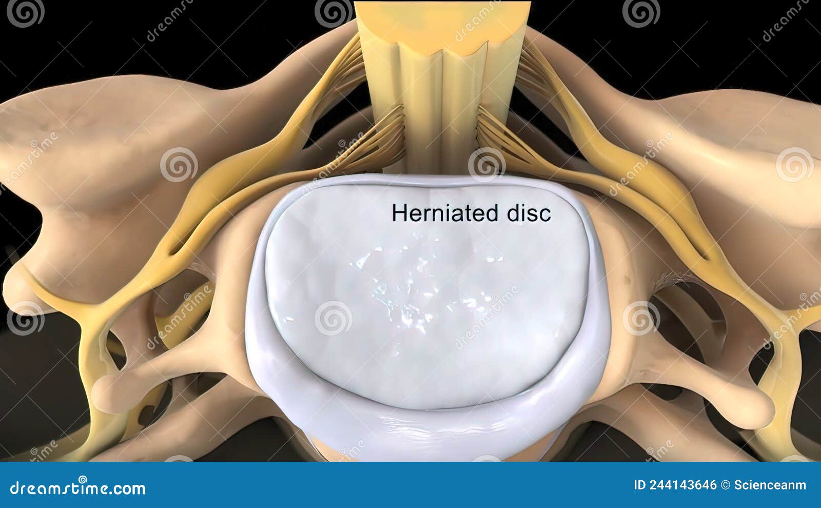 Disc Protrusion. Top View. Spine. Infographics. Vector Illustration On ...
