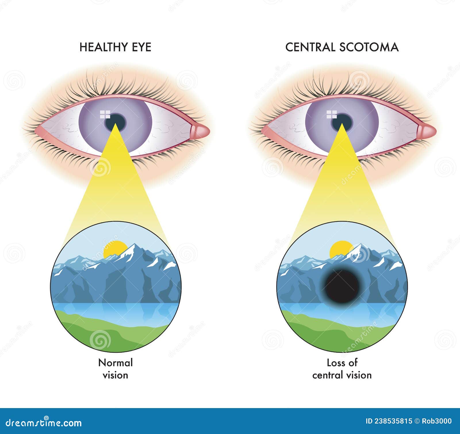 Central scotoma stock illustration. Illustration of medical - 238535815