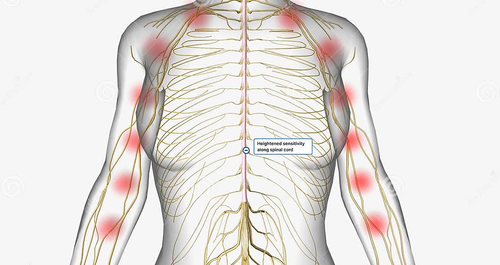 Central Sensitization, Also Called Central Pain, is a Condition ...