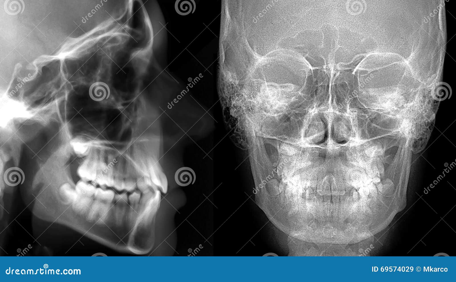 Cephalometric: Front and Side Profile Stock Image - Image of therapy ...