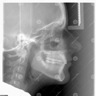 Cephalometric X-ray Used in Dentistry and Orthodontics Stock Photo ...