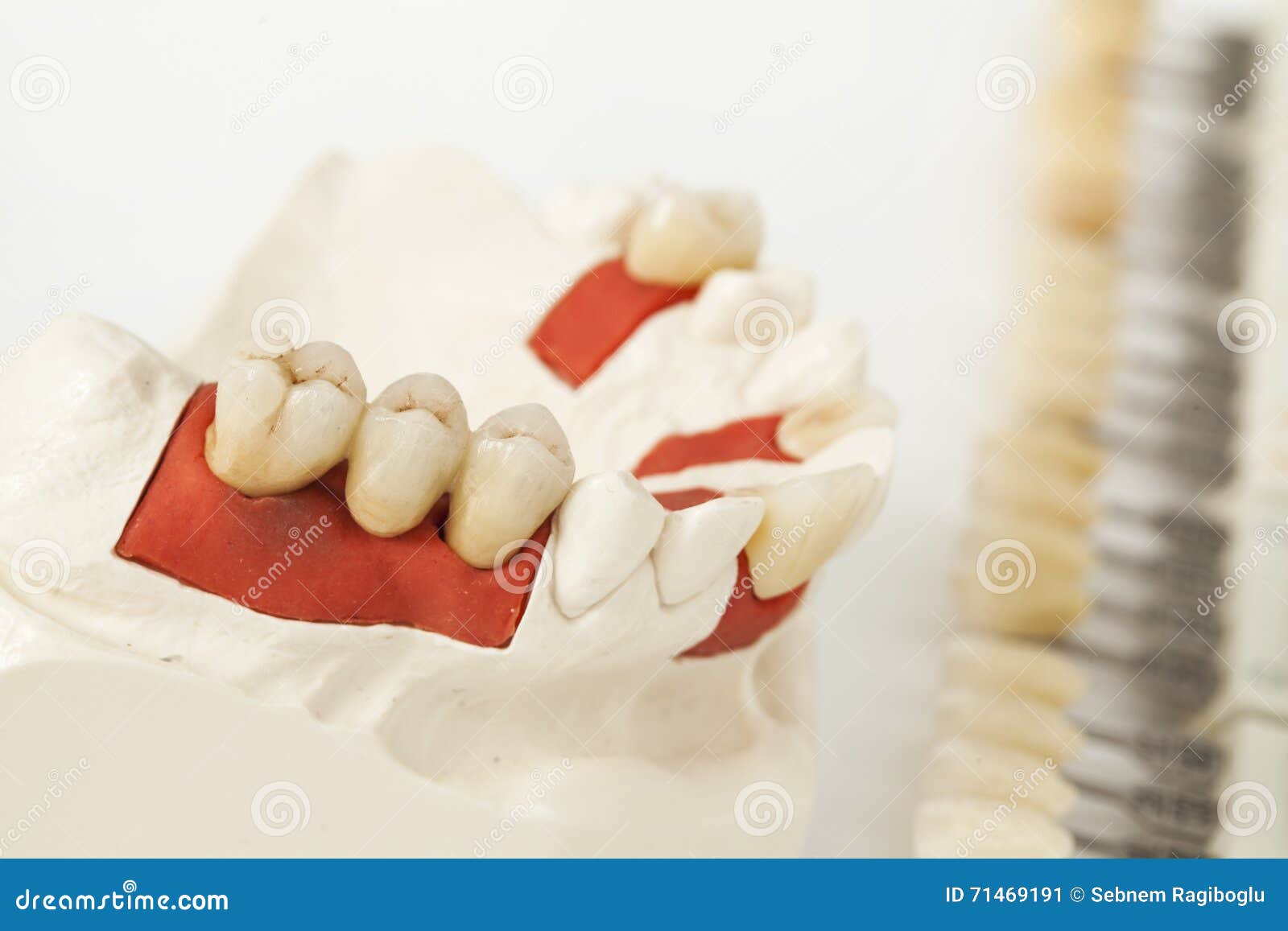 Ceramic Bridge on Plaster Model Stock Image - Image of full, hygiene ...