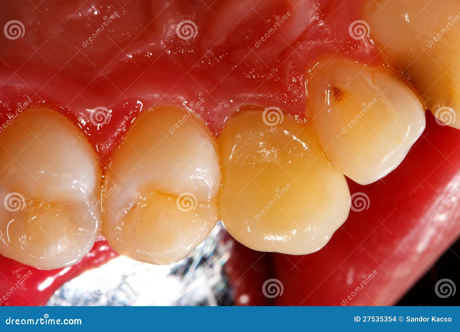 Ceramic crown on tooth stock photo. Image of prosthetics - 27535354