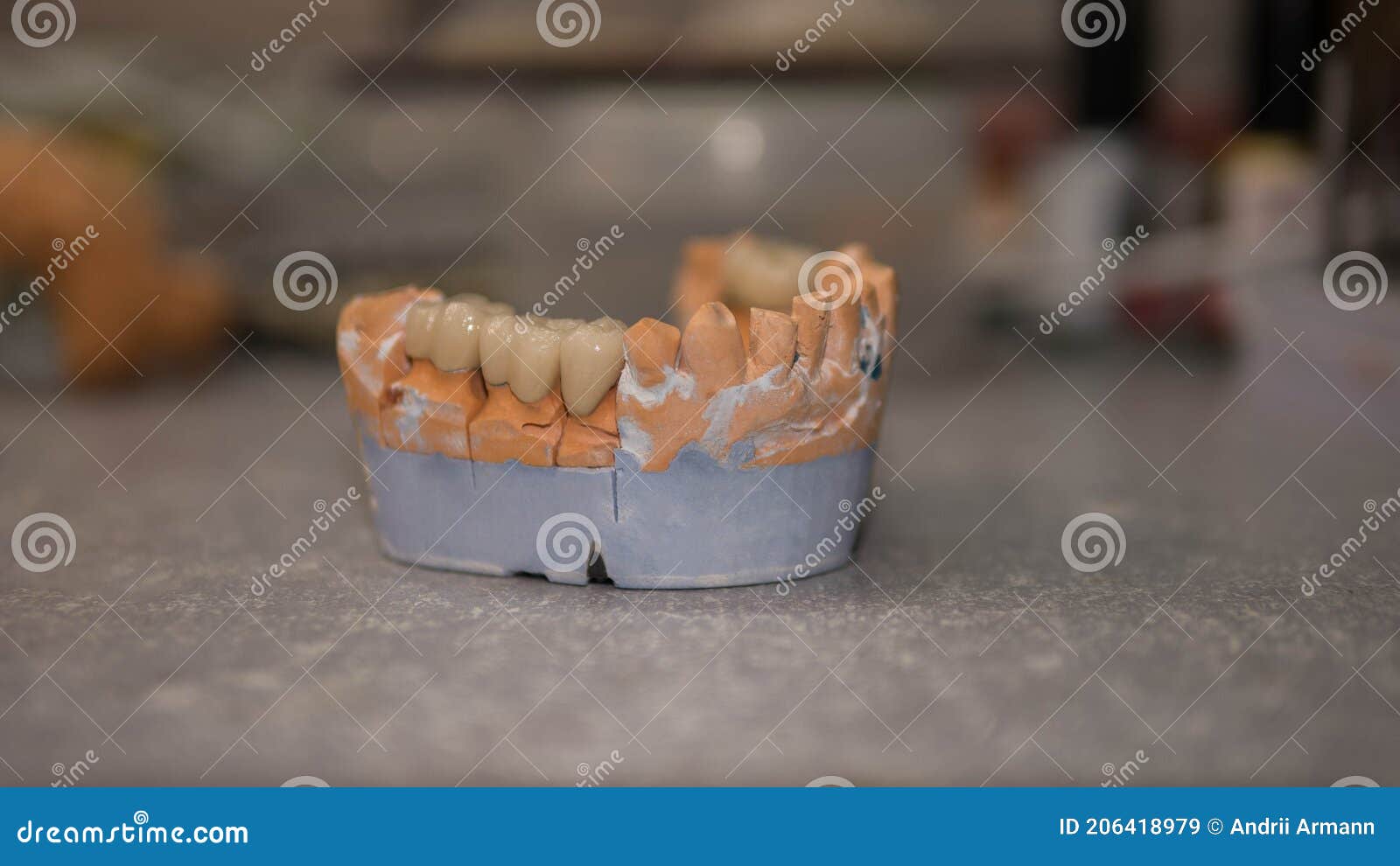 Ceramic Crown of a Tooth Based on a Plaster Model of Teeth, the Work of ...