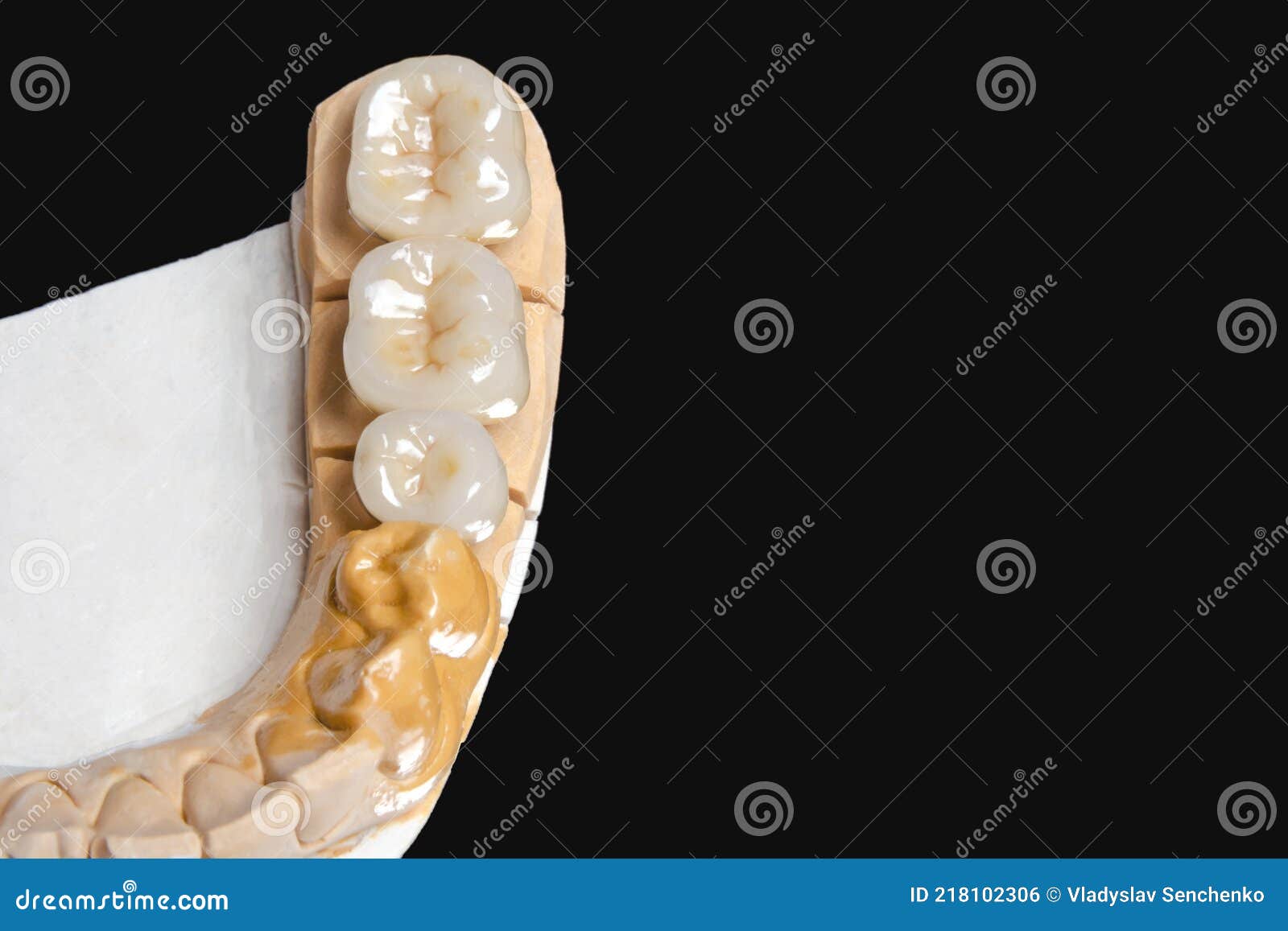 Ceramic Dental Bridge for Molars and Premolars. on a Black Background ...
