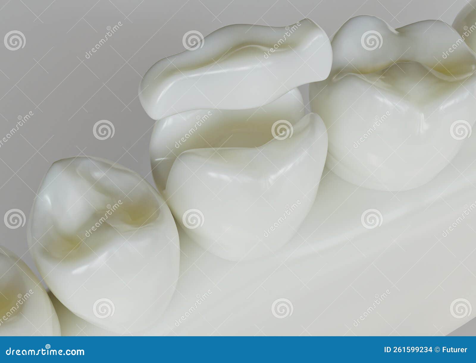 Inlay Ceramic Crown Installation In To The Tooth. Medically Accurate 3D ...