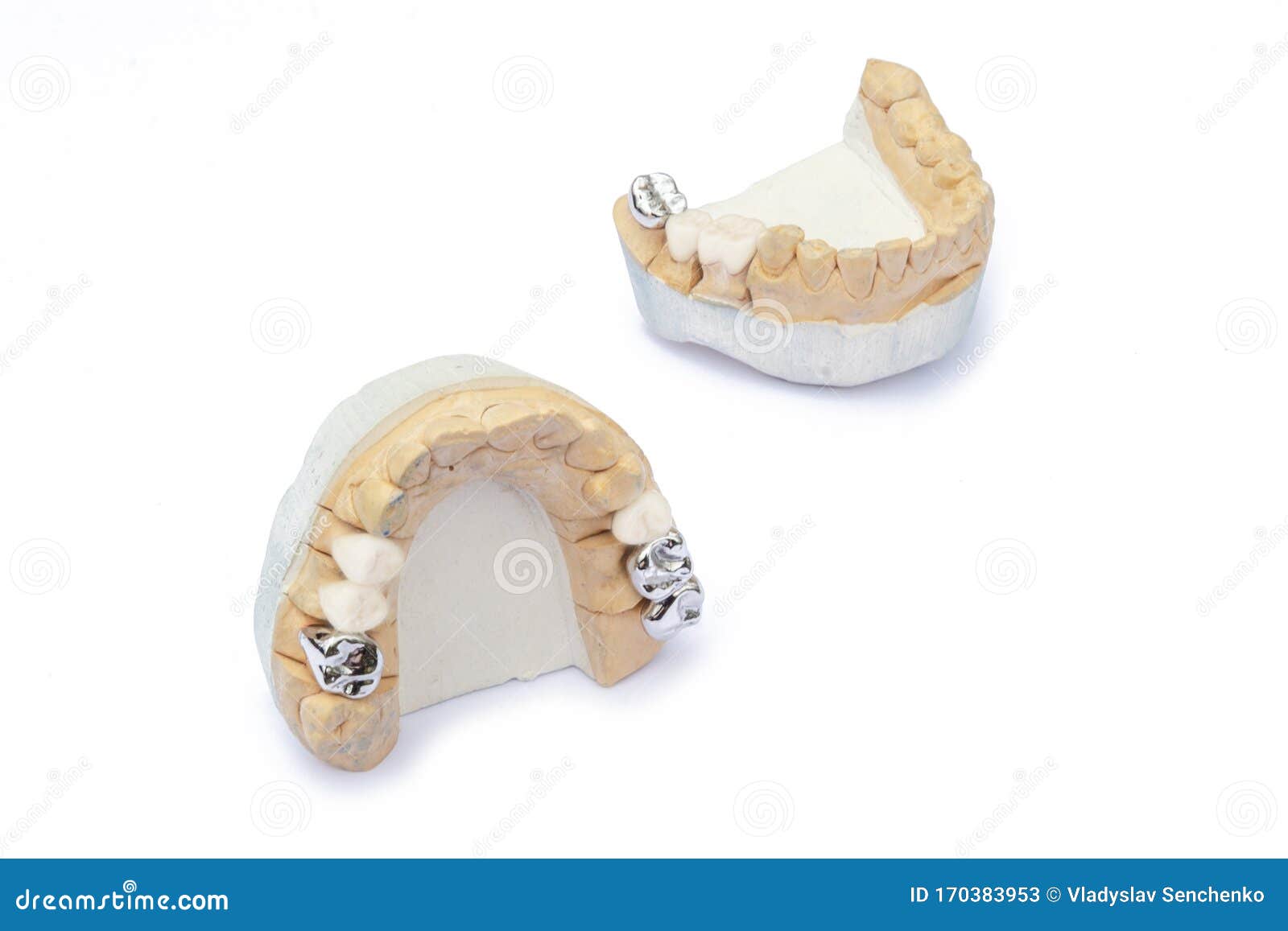 Ceramic-metal Bridges On The Models Of The Upper And Lower Jaws ...