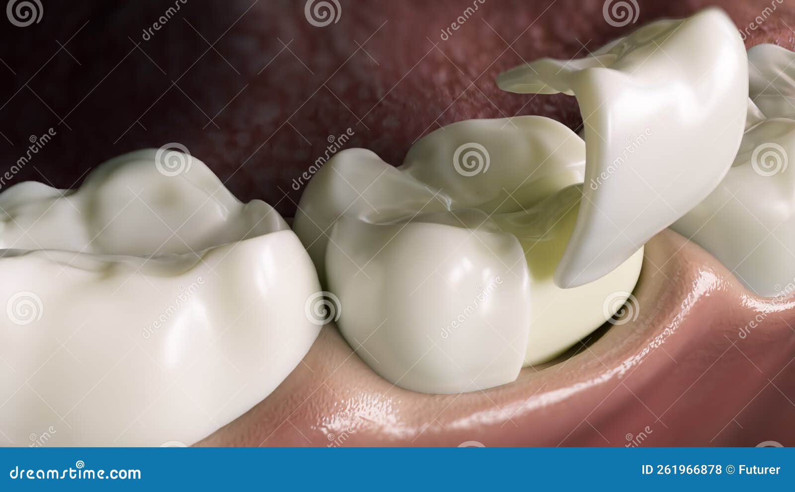 Onlay Ceramic Crown Fixation Over Molar Tooth. Medically Accurate 3D ...