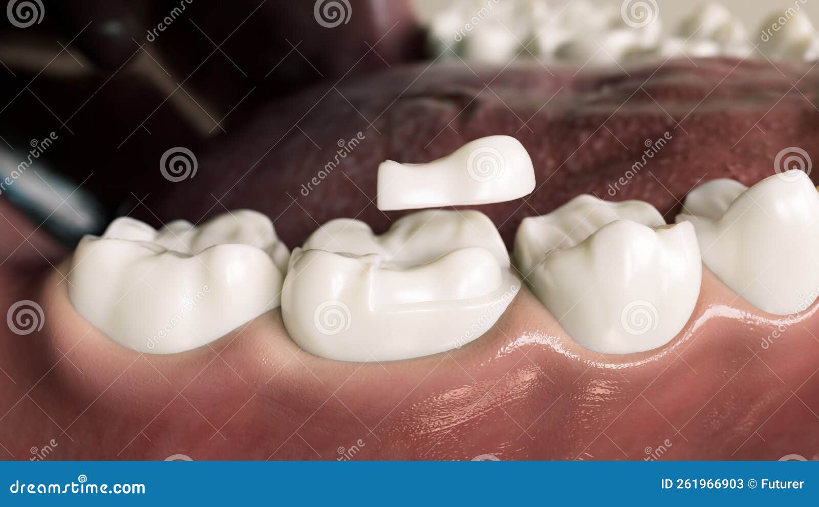 Onlay Ceramic Crown Fixation Over Molar Tooth. Medically Accurate 3D ...