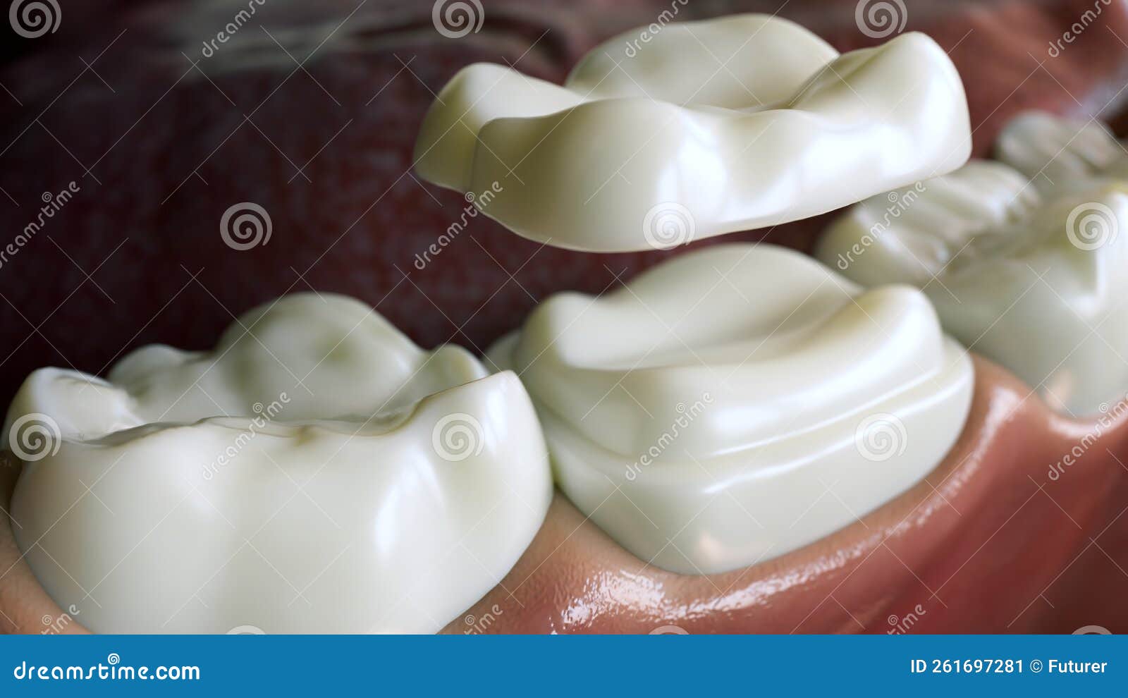 Ceramic Overlay Crown Over a Tooth- 3D Rendering Stock Illustration ...