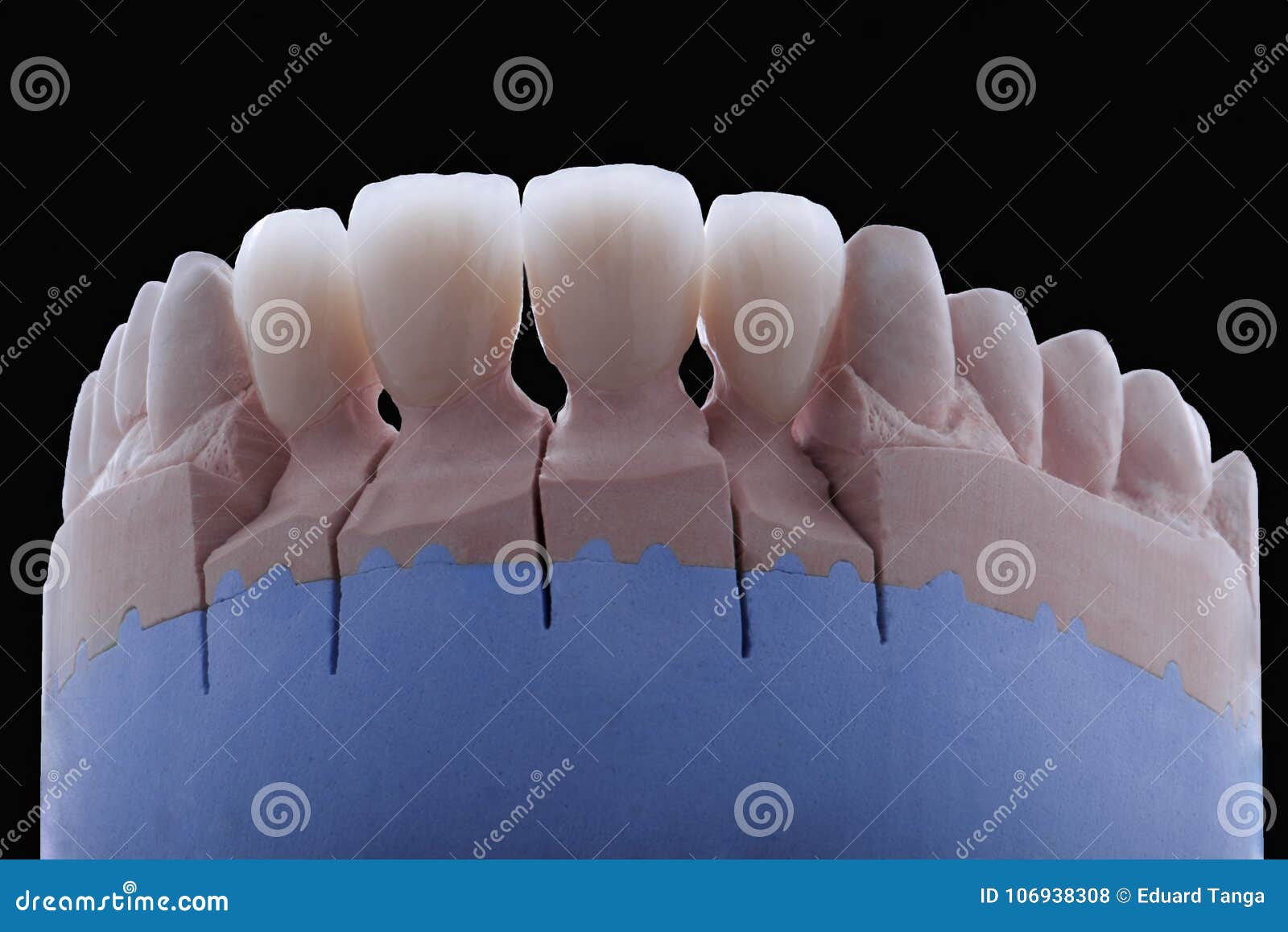 Ceramic Teeth On A Plaster Model On A Black Background Royalty-Free ...