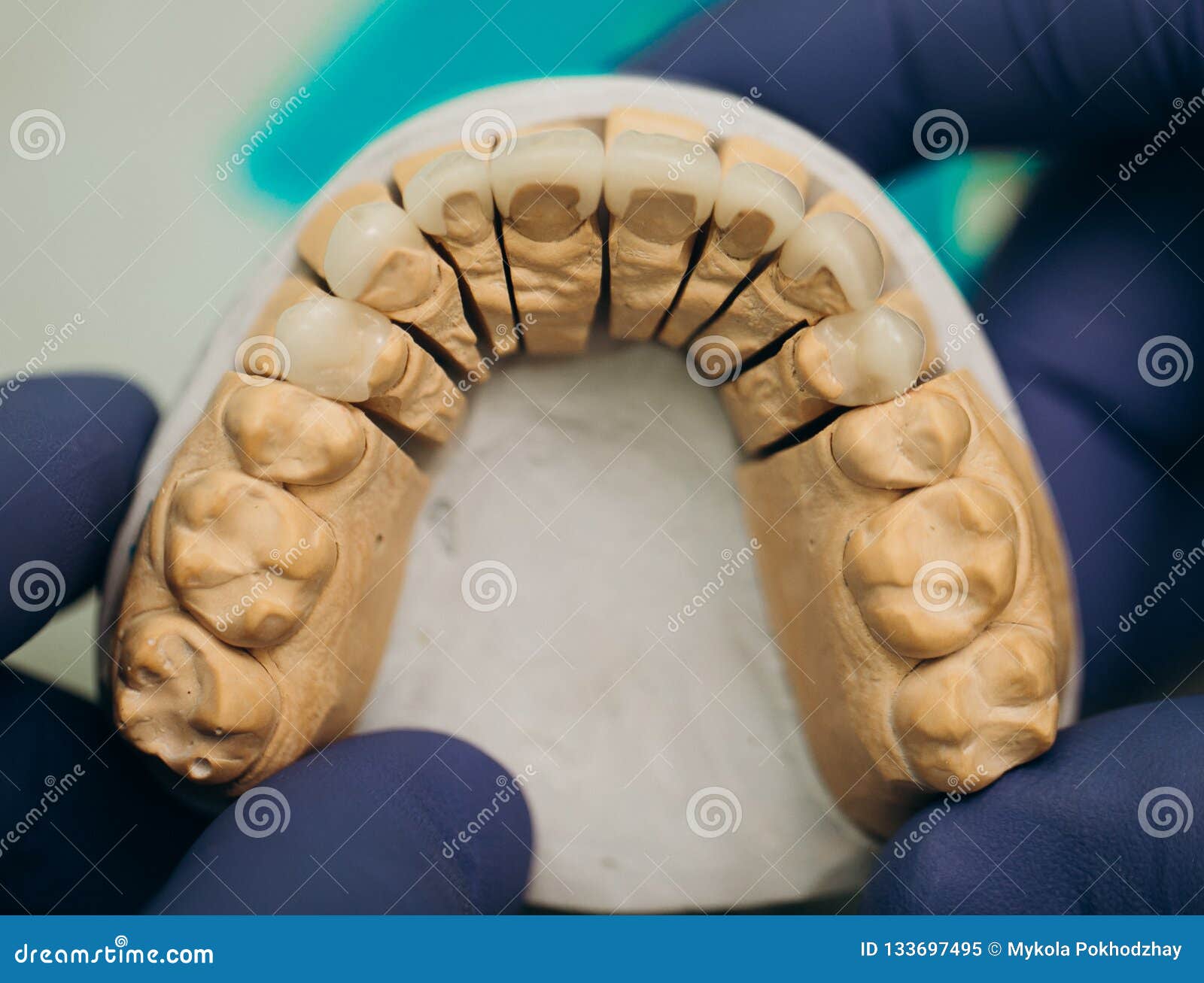 Ceramic Teeth Dental Crowns on Model .Ceramic Front Veneers. Stock ...