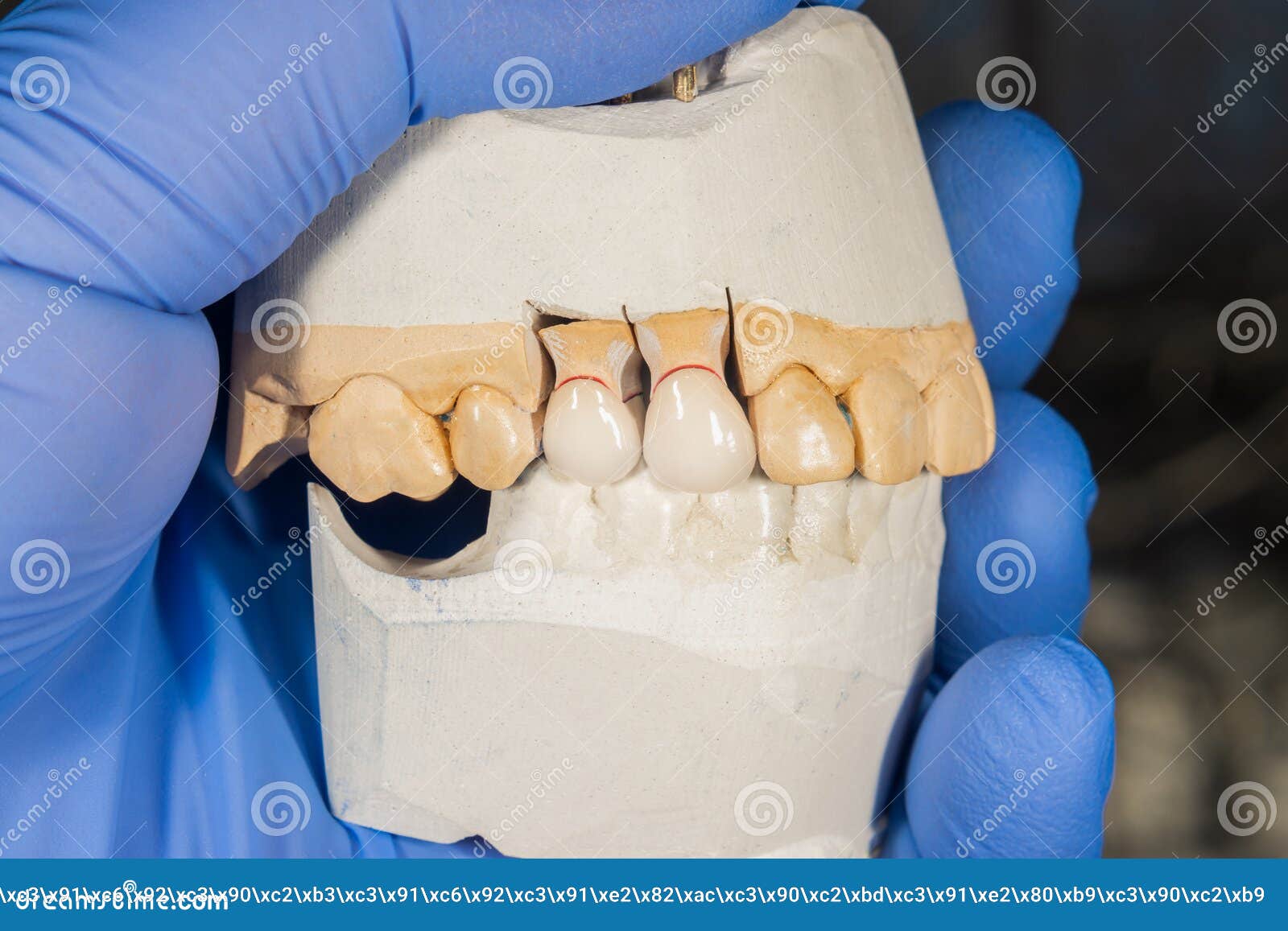 Ceramic Tooth Crown Close-up on a Plaster Model. Dental Prosthesis ...
