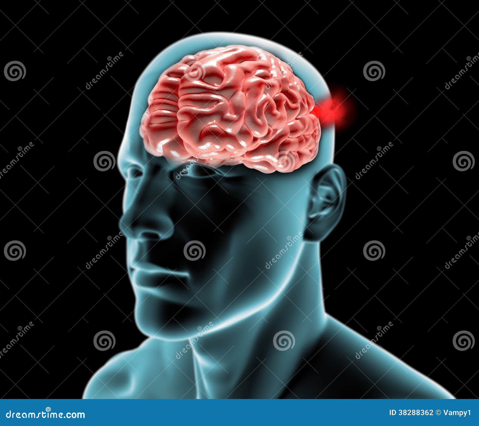 Cerebral Aneurysm, Brain Head Stock Illustration - Illustration of room ...