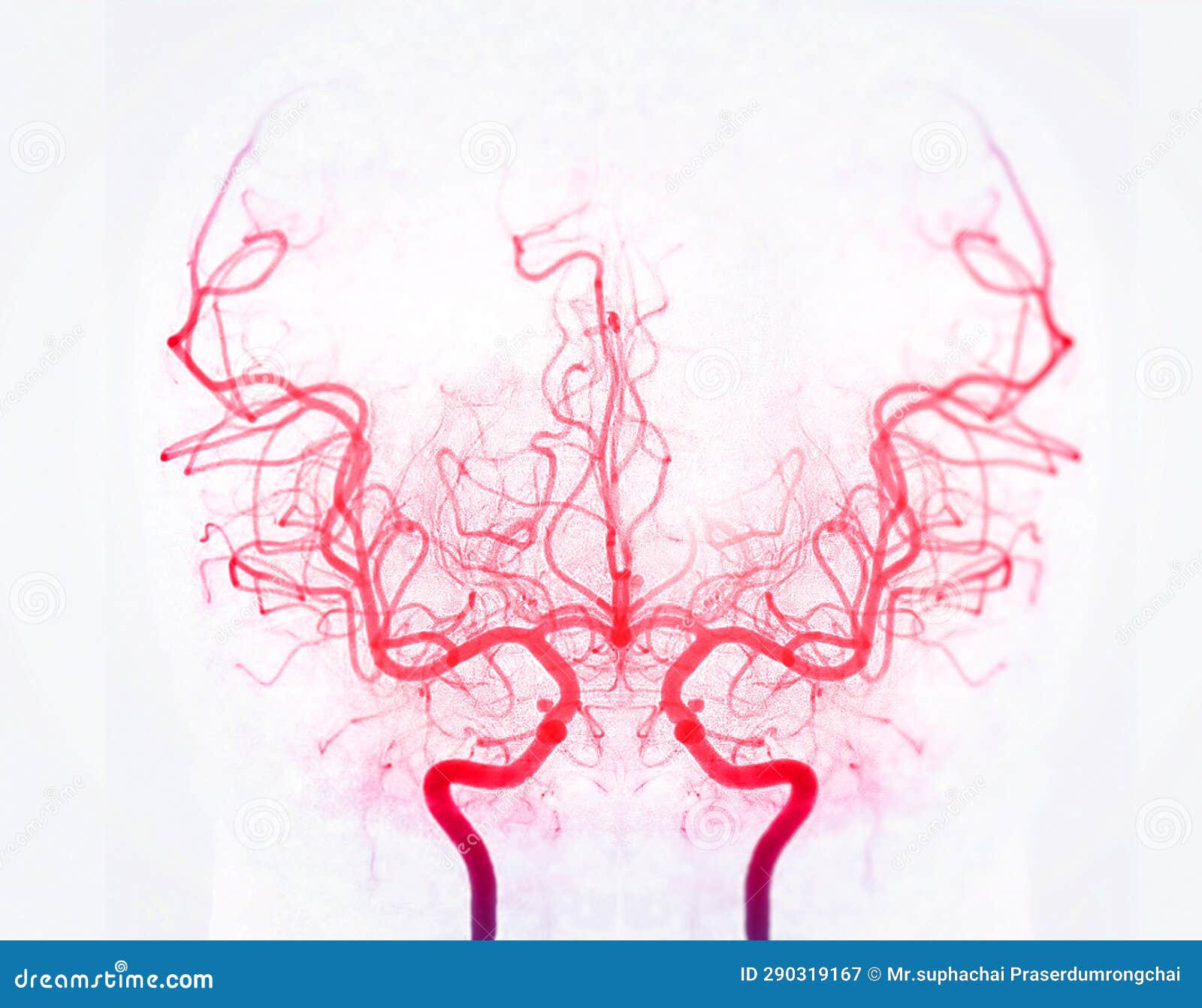 Cerebral Angiography Image from Fluoroscopy in Intervention Radiology ...