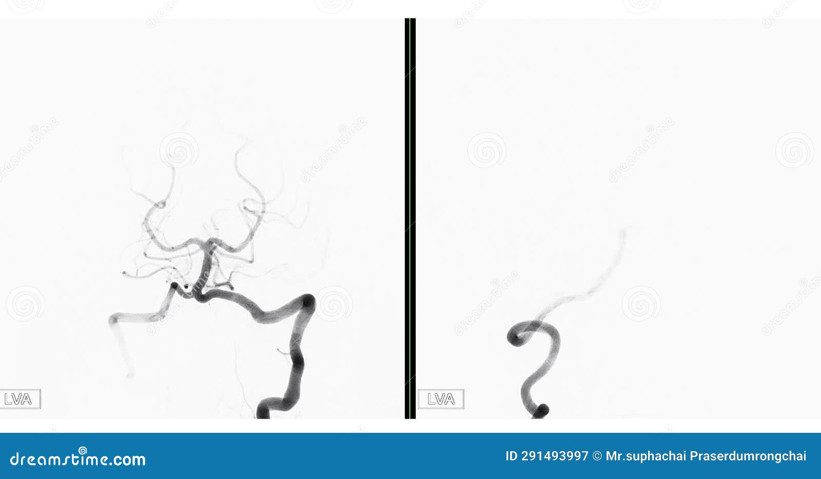 Cerebral Angiography Image From Fluoroscopy In Intervention Radiology ...