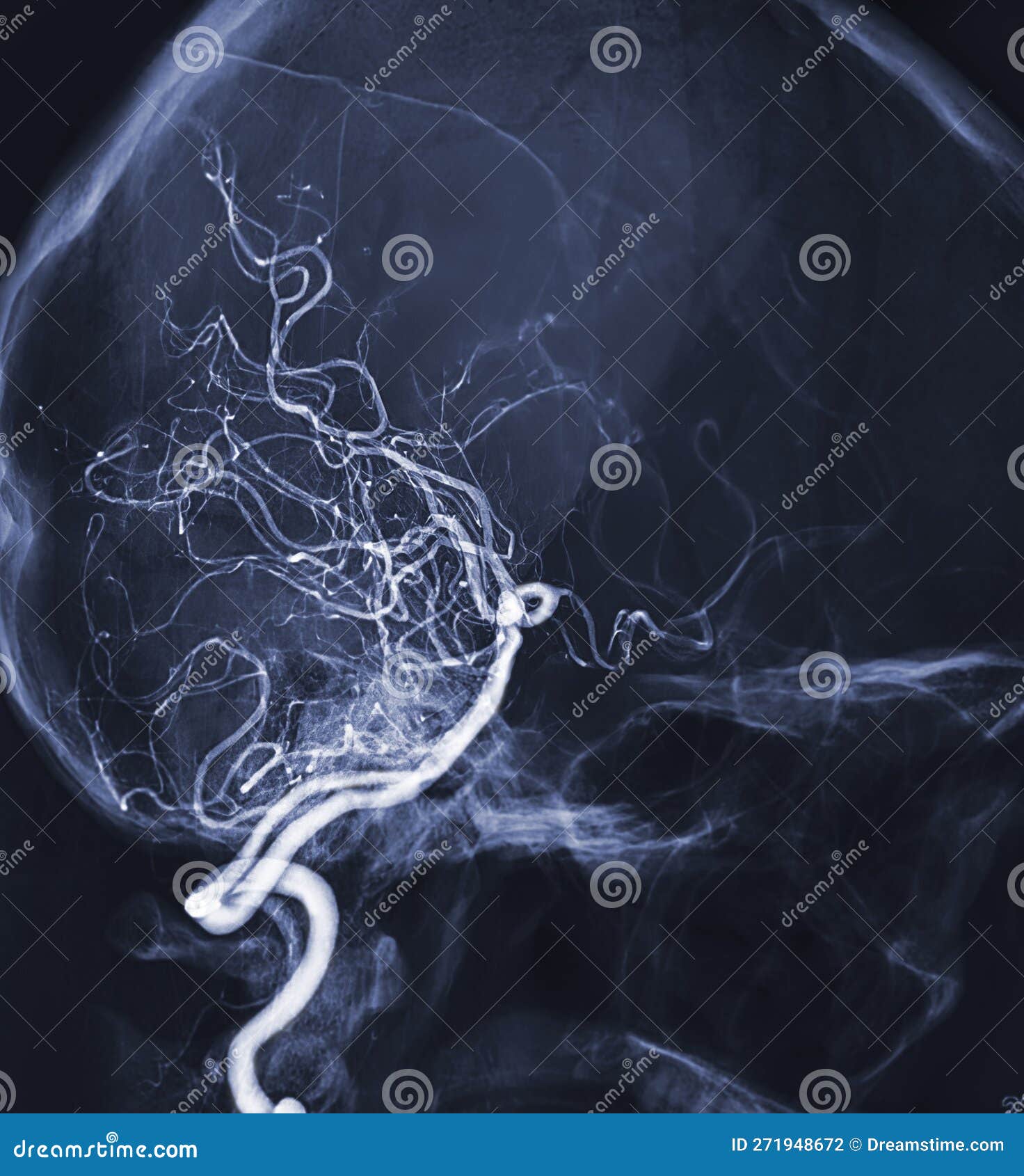 Cerebral Angiography Image From Fluoroscopy In Intervention Radiology Showing Cerebral Artery