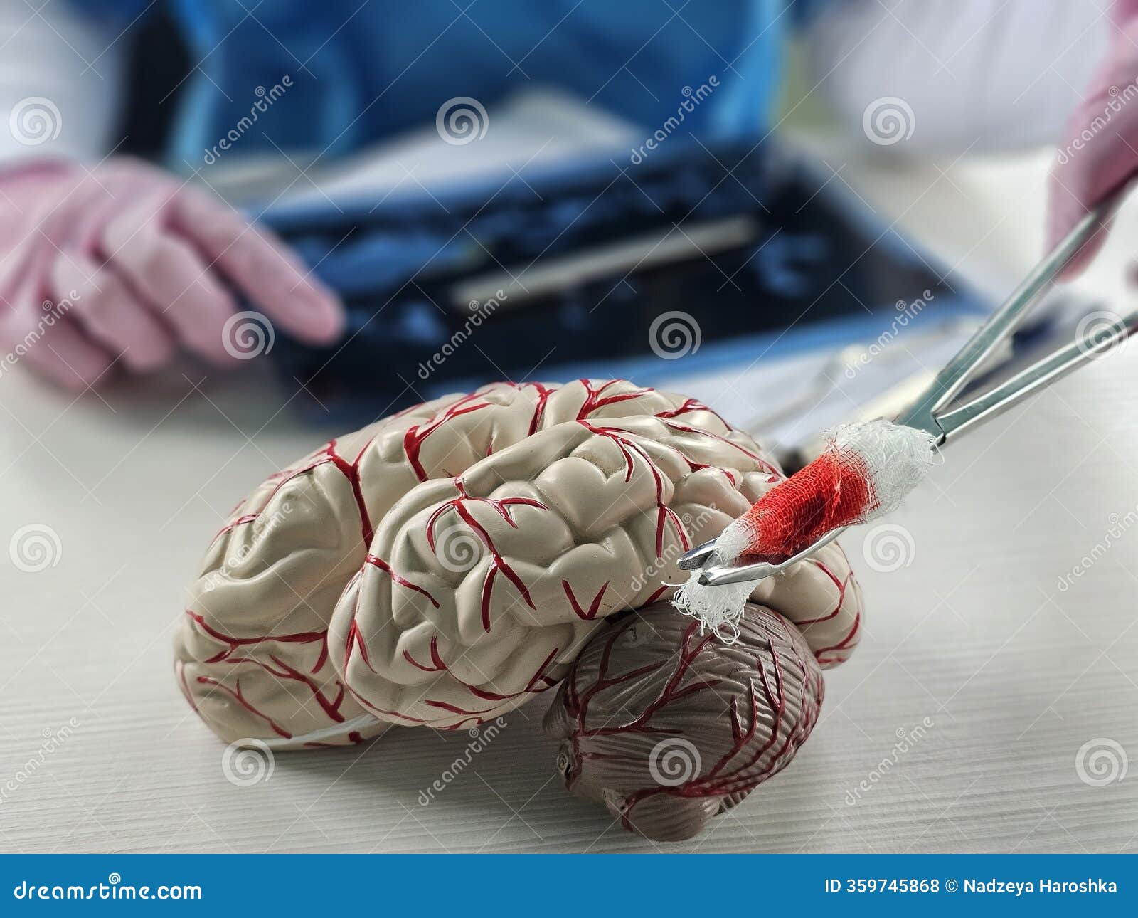 Cerebral Circulatory Disorder. Surgery for Cerebral Stroke Stock Photo ...