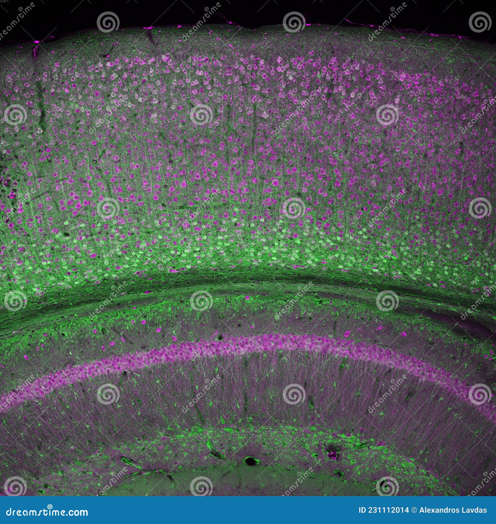 Immunofluorescence Confocal Imaging Of A Single Invading Metastatic ...