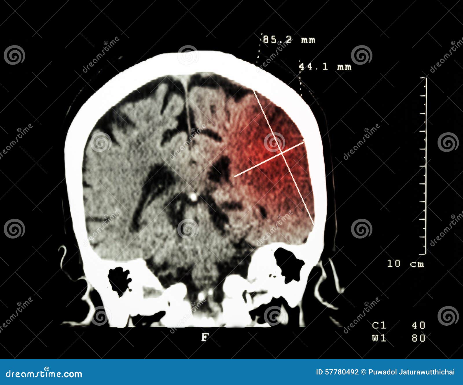 Cerebral Infarction at Left Hemisphere ( Ischemic Stroke ) ( CT-scan of ...