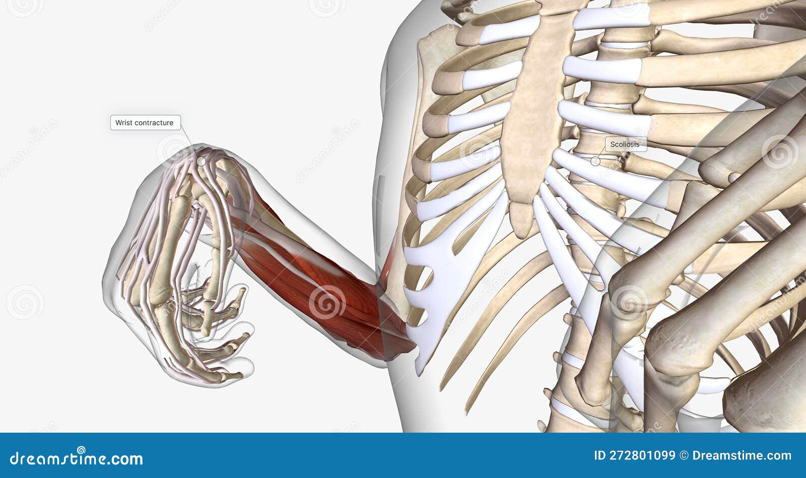The Cerebral Palsy, Wrist Conracture Stock Illustration - Illustration ...