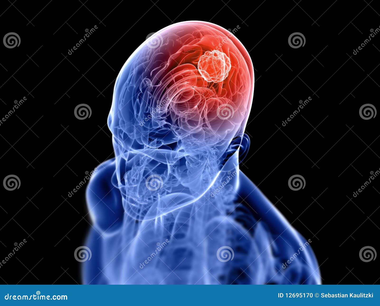 Cerebral tumor stock illustration. Illustration of biology - 12695170