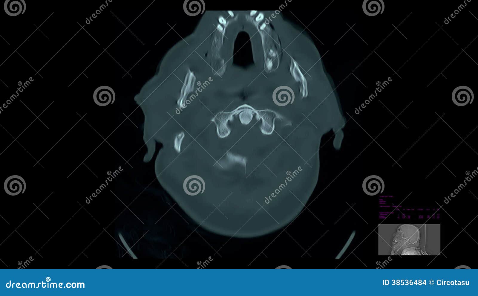 Cerebral venous congestion stock video footage. Video of exam - 38536484