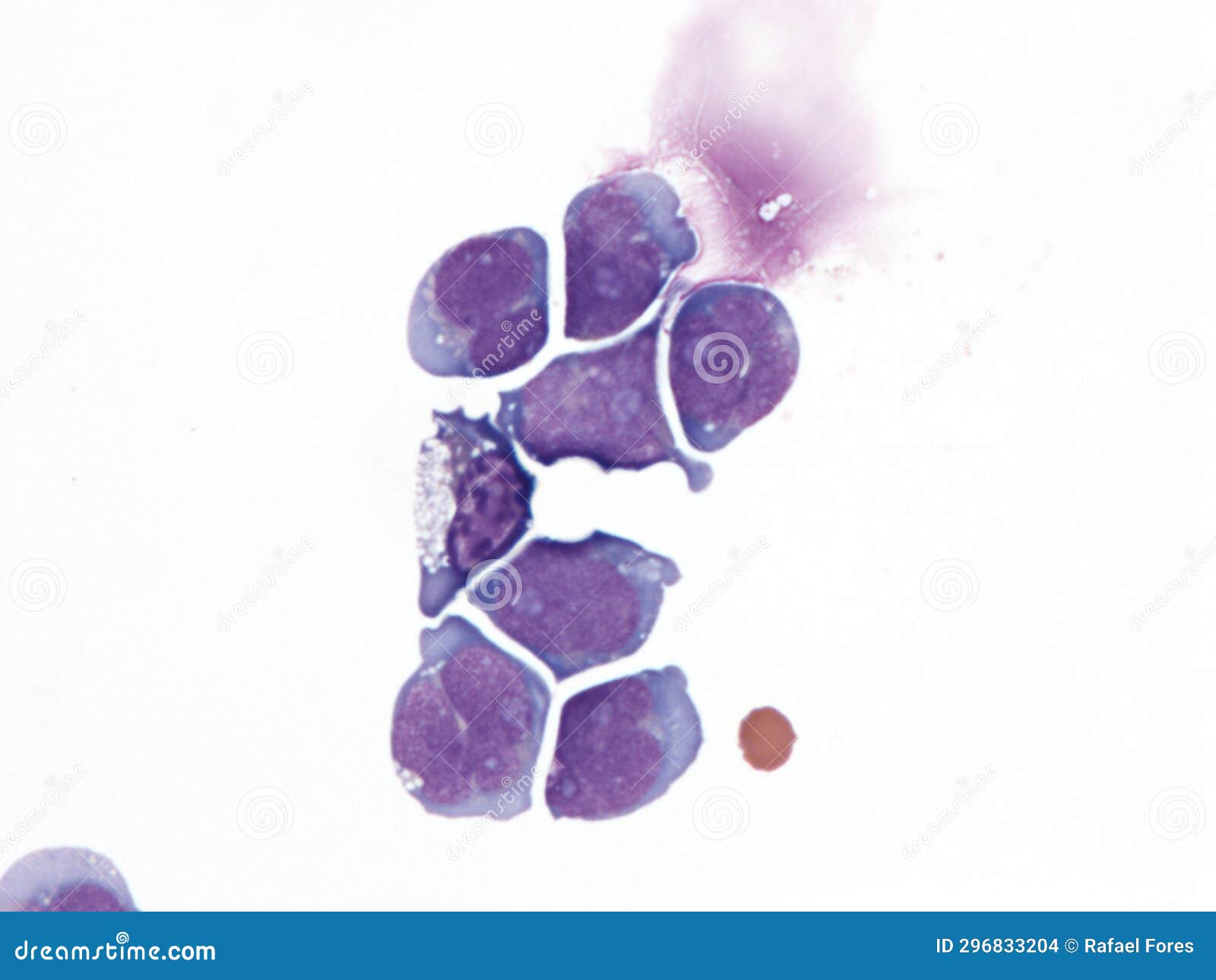 Diffuse Large B Cell Lymphoma with Meningeal Involvement. Stock Photo ...