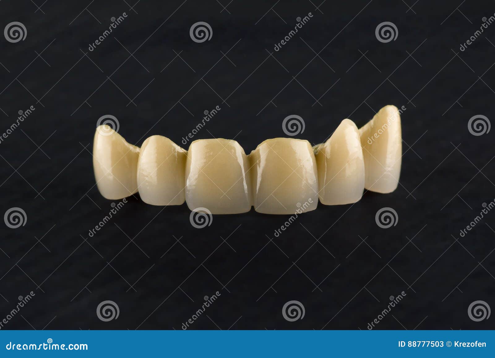 Cermet tooth crowns stock image. Image of dentures, artificial - 88777503