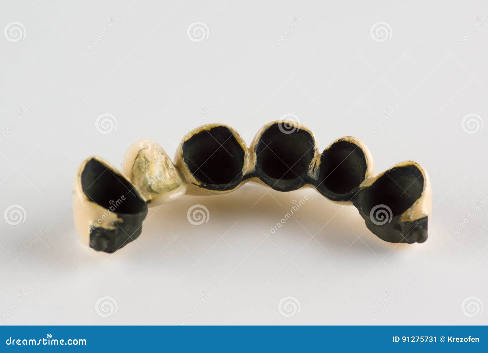 Cermet tooth crowns stock image. Image of medicine, opening - 91275731