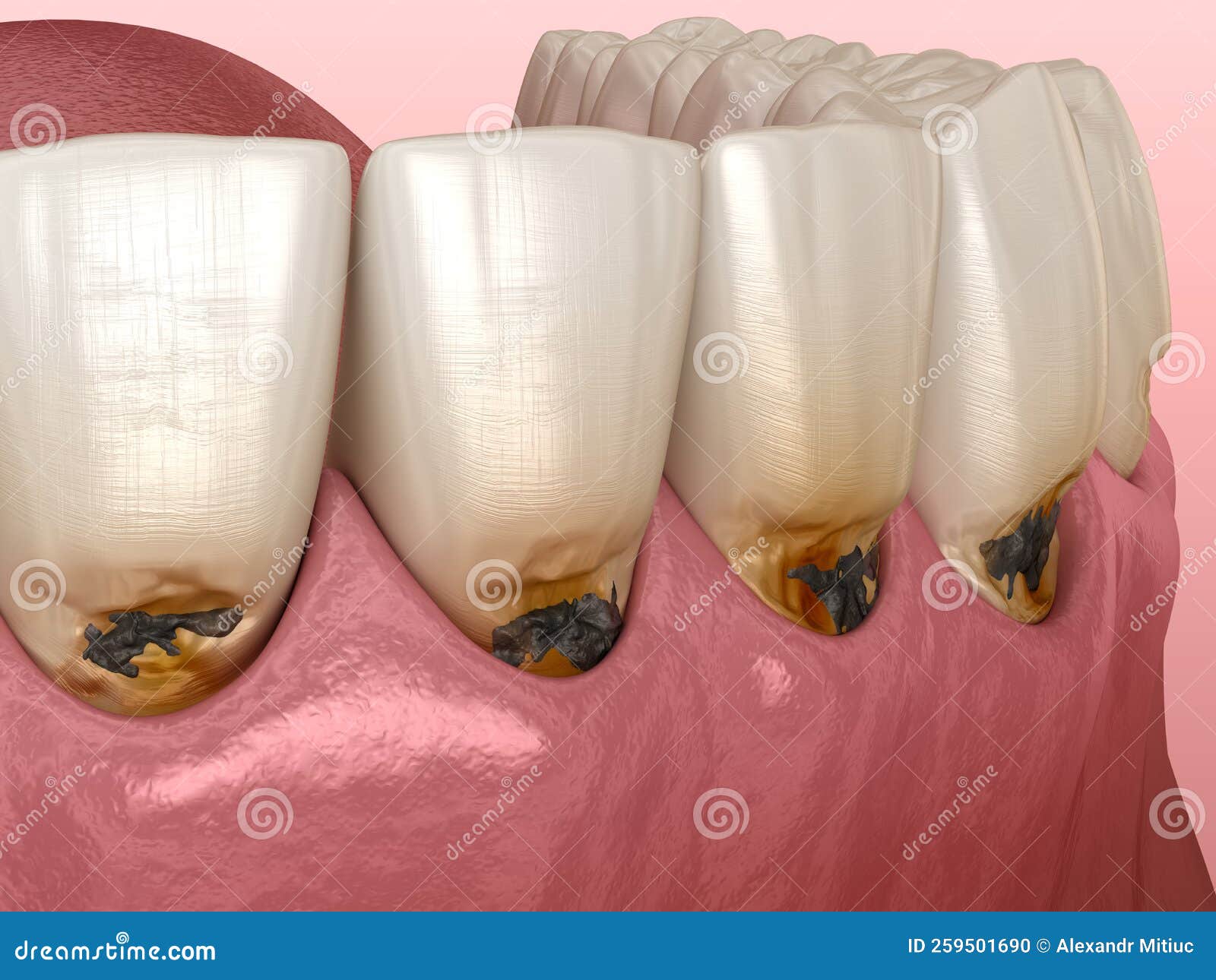 Cervical Caries on Frontal Teeth. Medically Accurate Tooth 3D ...
