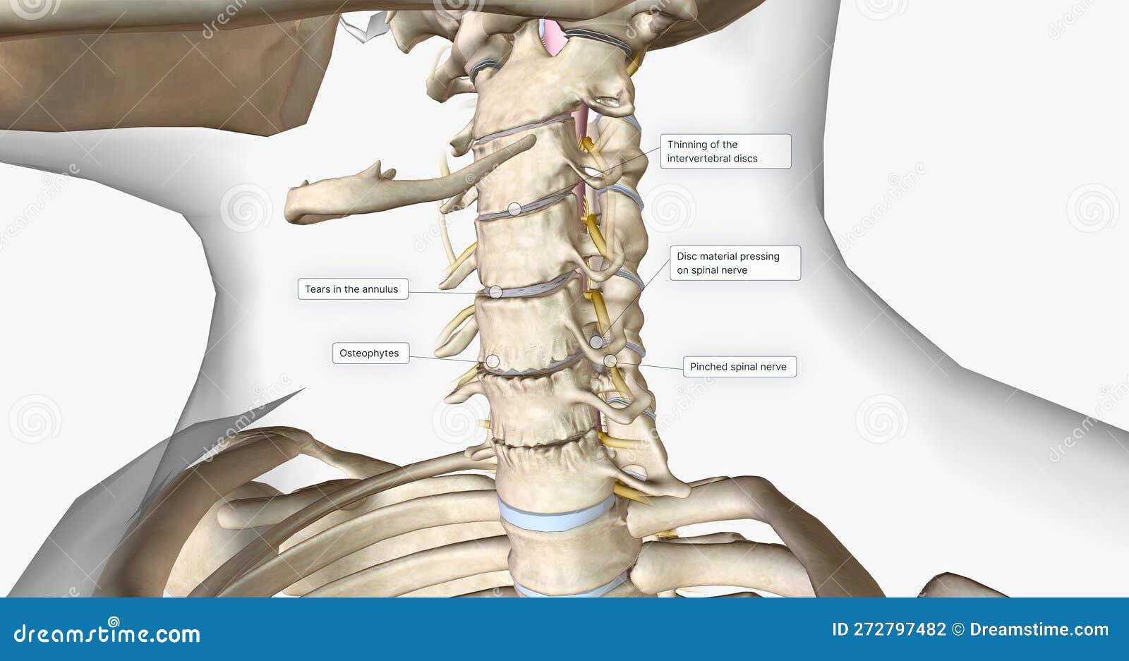 Cervical Disc Degeneration, or Cervical Disc Disease, is a Process that ...