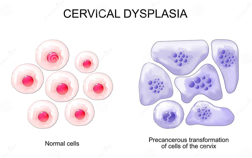 Cervical Dysplasia Cervical Cancer Stock Vector Illustration Of