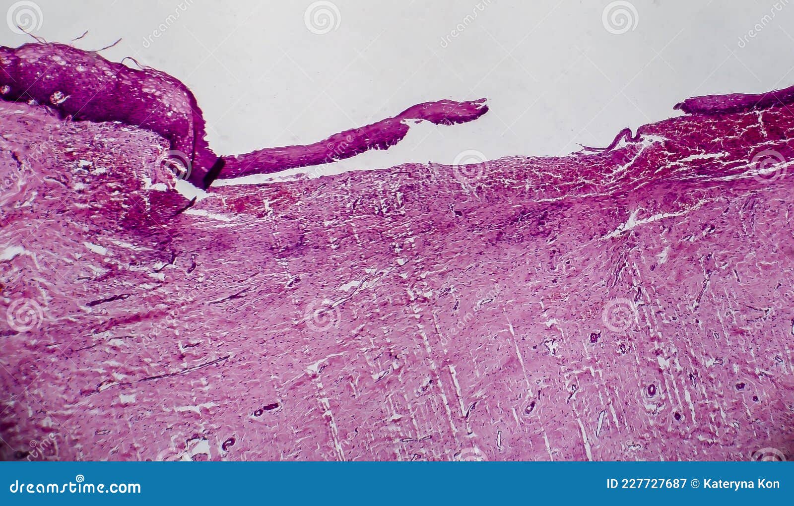 Cervical Ectropion, Light Micrograph Royalty-Free Stock Photo ...