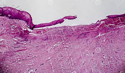 Cervical Ectropion, Light Micrograph Stock Image - Image of cervix ...