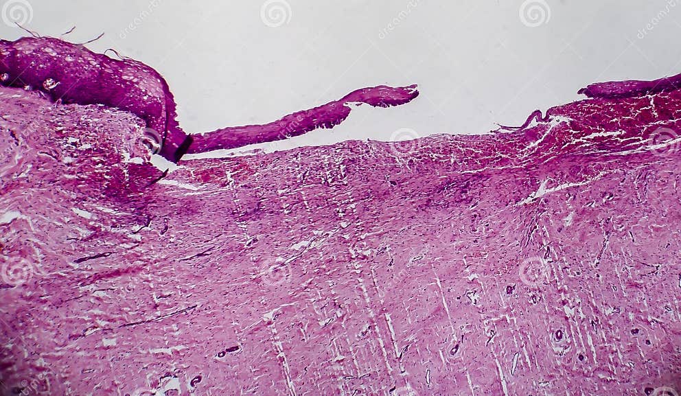Cervical Ectropion, Light Micrograph Stock Image - Image of cervix ...