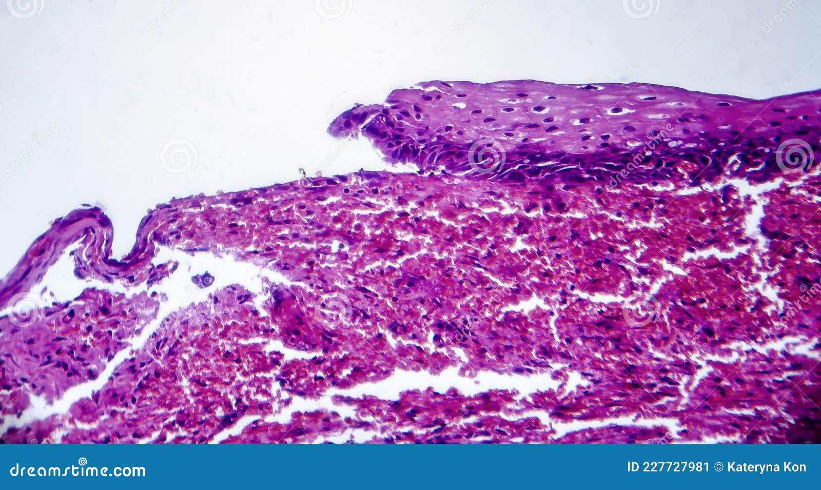 Cervical Ectropion, Light Micrograph Royalty-Free Stock Photo ...