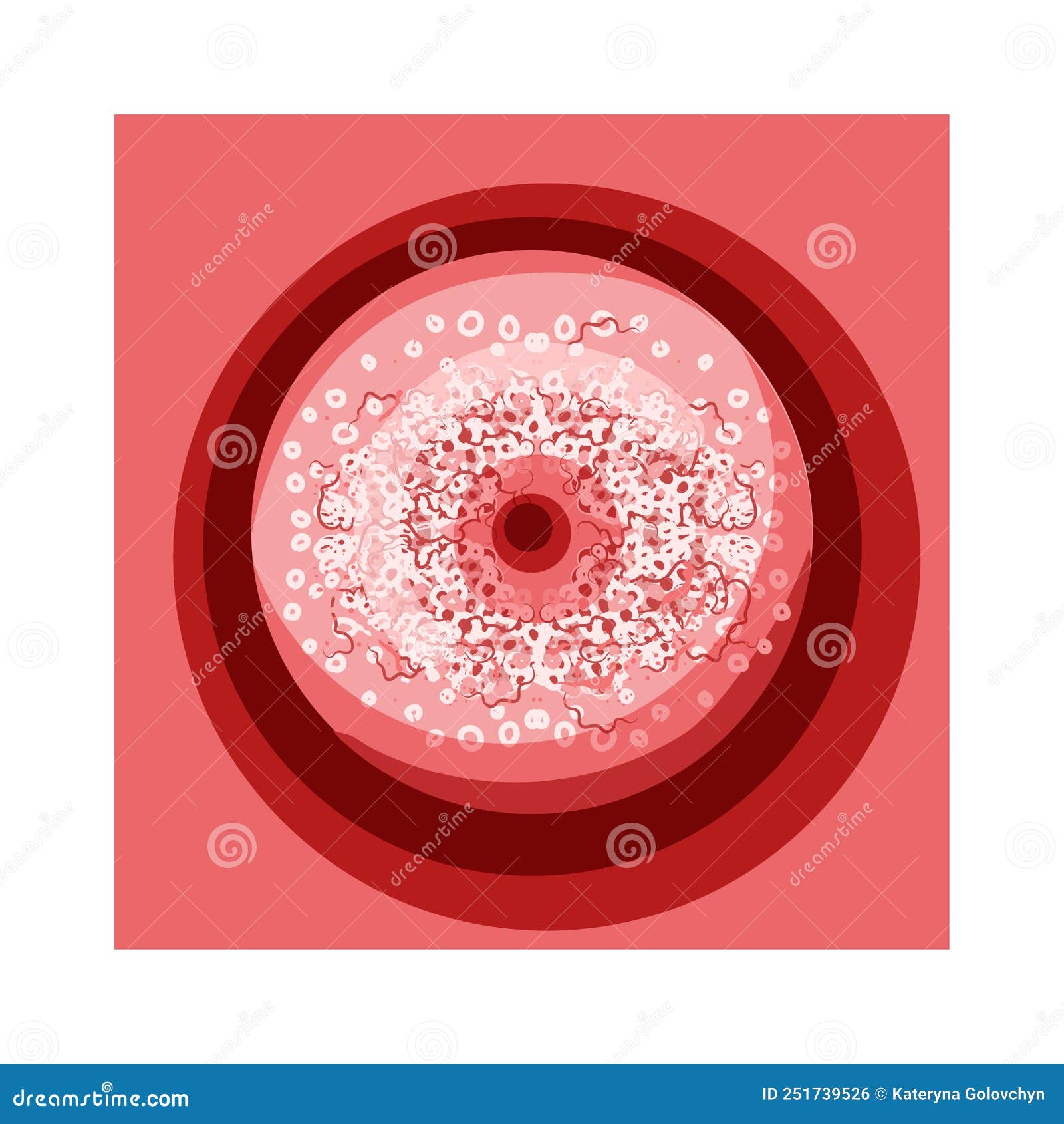 Cervical Invasive Cancer Dysplasia Stage Infographic Female