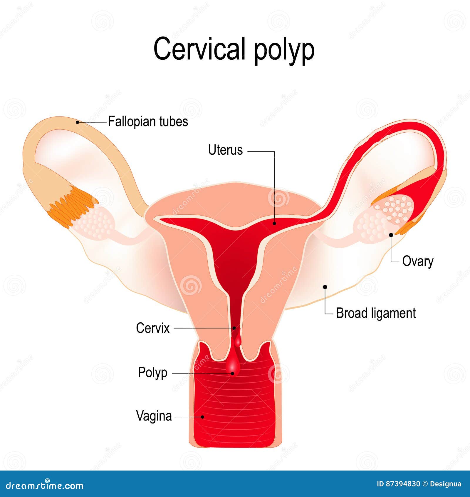Cervical Polyp On The Uterus Stock Vector Illustration Of Cervix