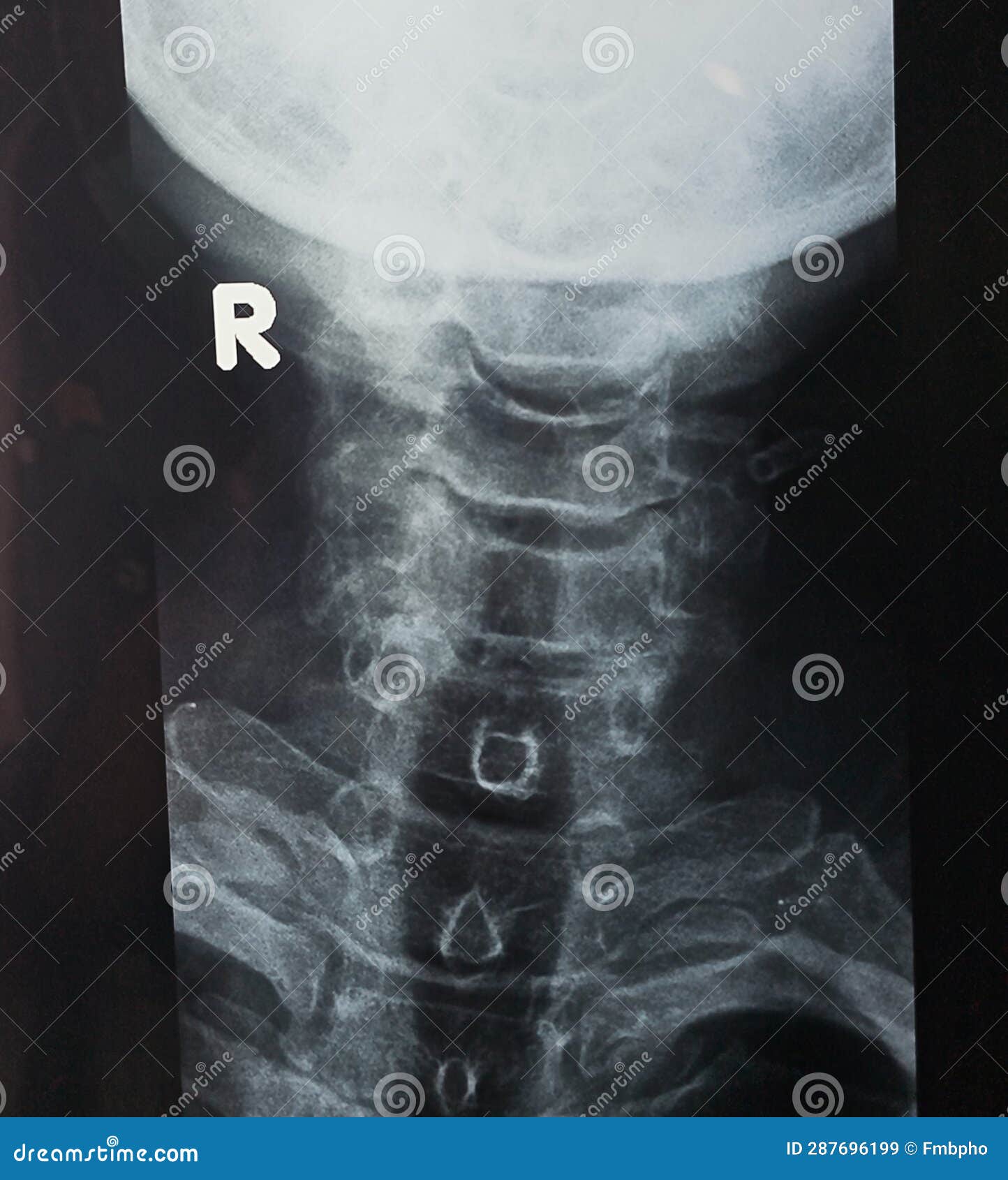 Cervical Spine X-ray without Fractures and Dislocations Stock Image ...