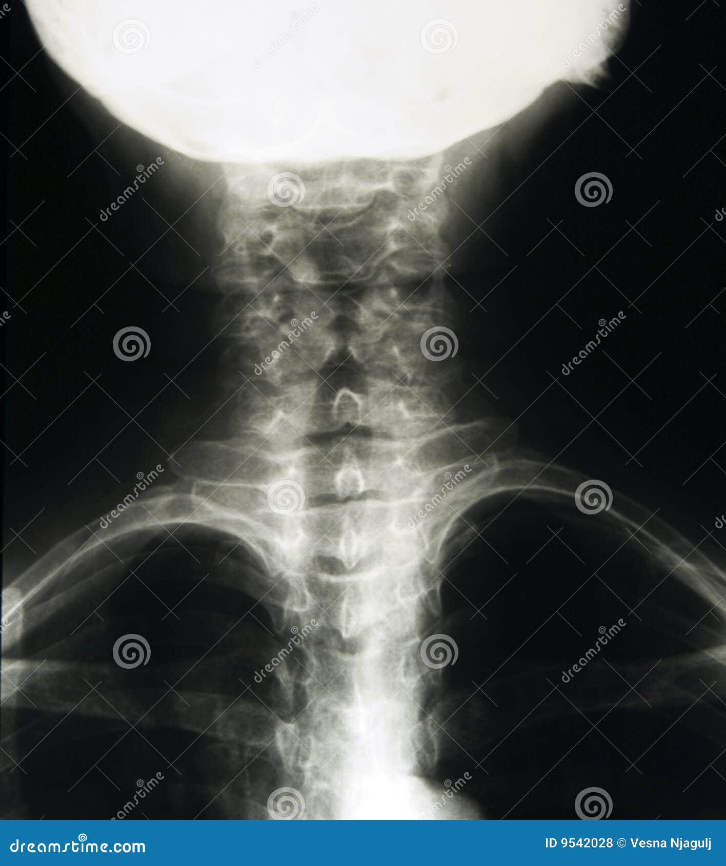 Cervical spine x-ray, neck stock photo. Image of discus - 9542028
