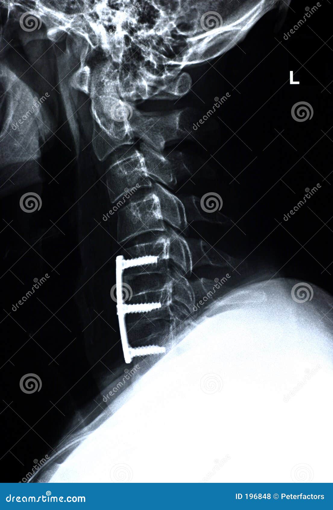 X-ray Of The Cervical Spine Showing Thoracic Scoliosis With Cervical ...